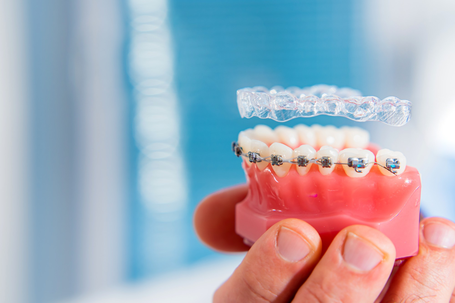 ¿Brackets O Invisalign?