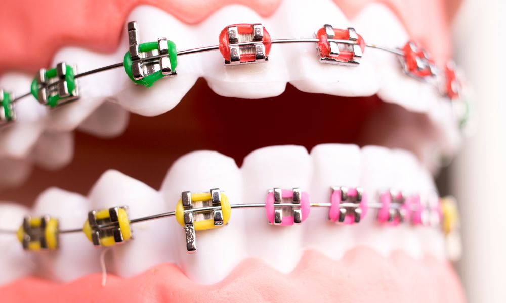 Ligas De Los Brackets ¿sabes Para Qué Sirven? | Blog