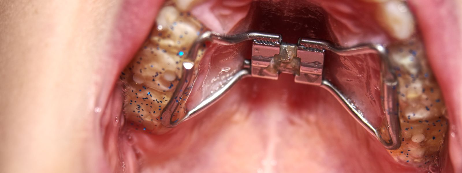 Expansor De Paladar ¿Qué Es Y Para Qué Sirve? | Blog