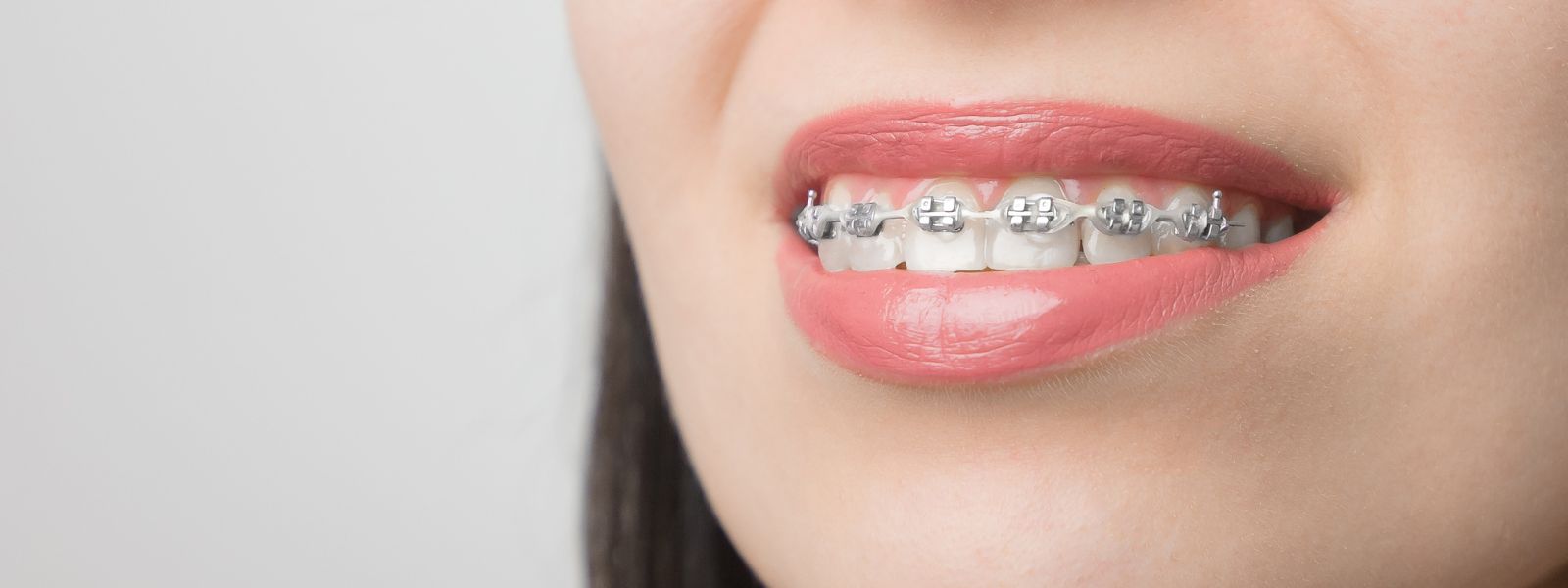 Ligas De Los Brackets ¿sabes Para Qué Sirven? | Blog