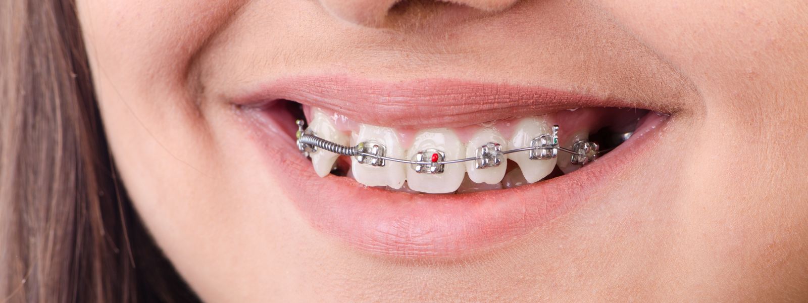 Brackets En Porcelana: Estética Y Funcionalidad