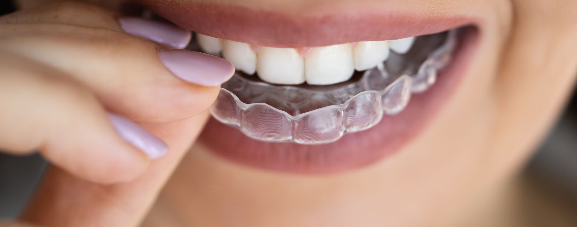 Explore Types of Dental Aligners and Benefits