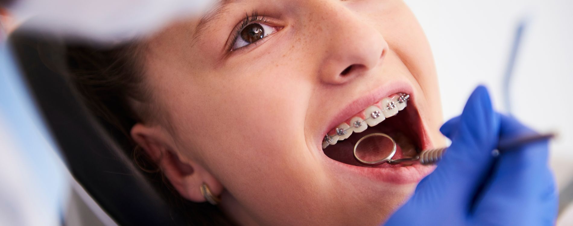 Usos Y Beneficios Del Arco Lingual En Ortodoncia