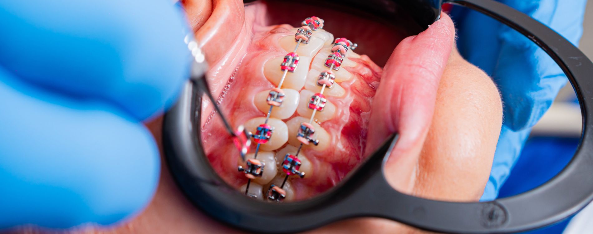 Análisis Facial Ortodoncia Guía Para Tu Tratamiento